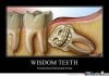 25 Wisdom Teeth Memes That Are Too Funny For Words - SayingImages.com